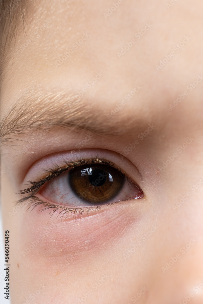 Eye of a child with conjunctivitis, inflammation of the conjunctiva ...