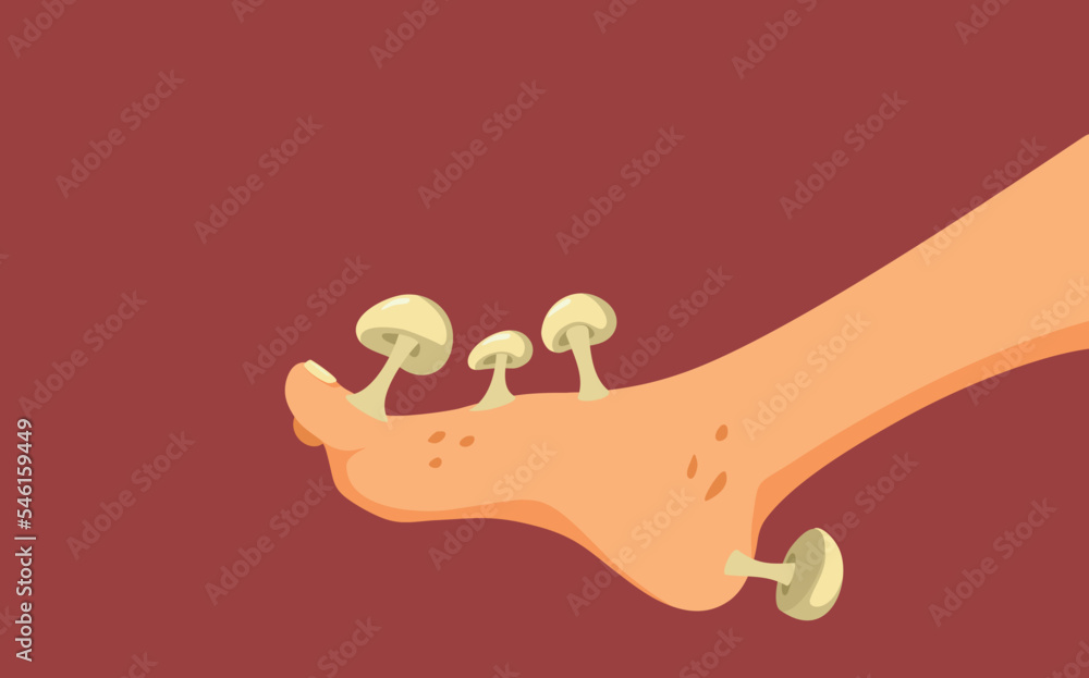 Vecteur Stock Foot with Fungus Problem Concept Cartoon Illustration ...