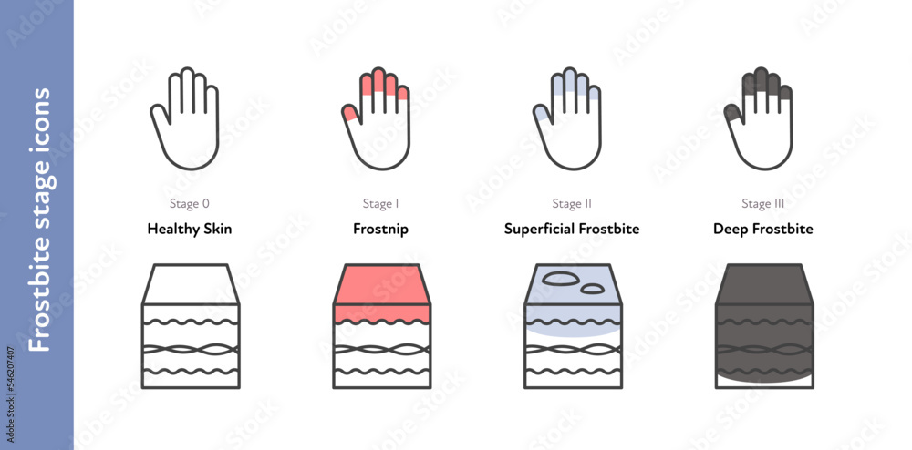 Frostbite anatomical icon set. Vector flat healthcare illustration ...
