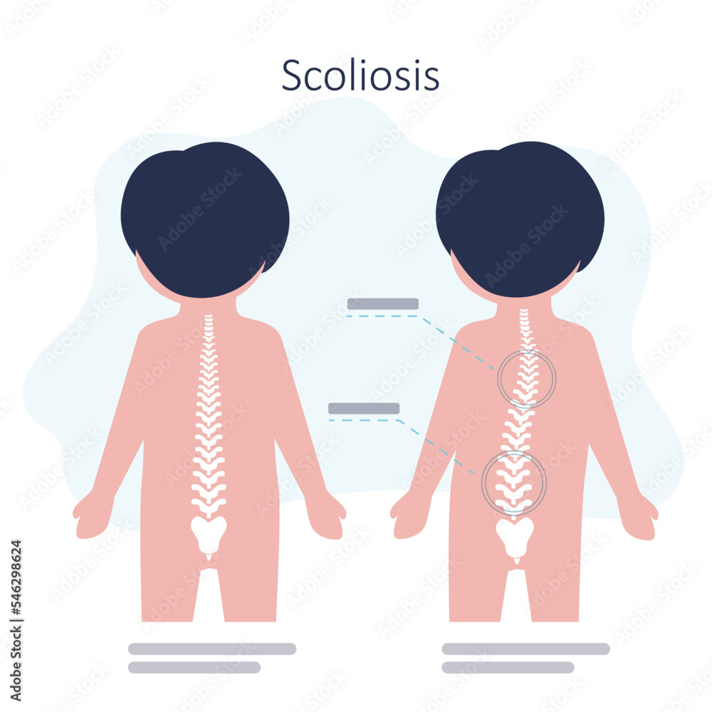 Educational poster with schoolboy have scoliosis problems. Child with ...