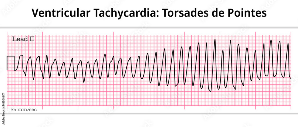 ECG Torsades de Pointes Ventricular Tachycardia - 8 Second ECG Paper ...