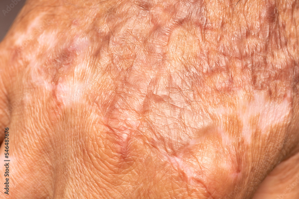 Burn Scars on the hands, Picture of the scar caused by an accident And ...