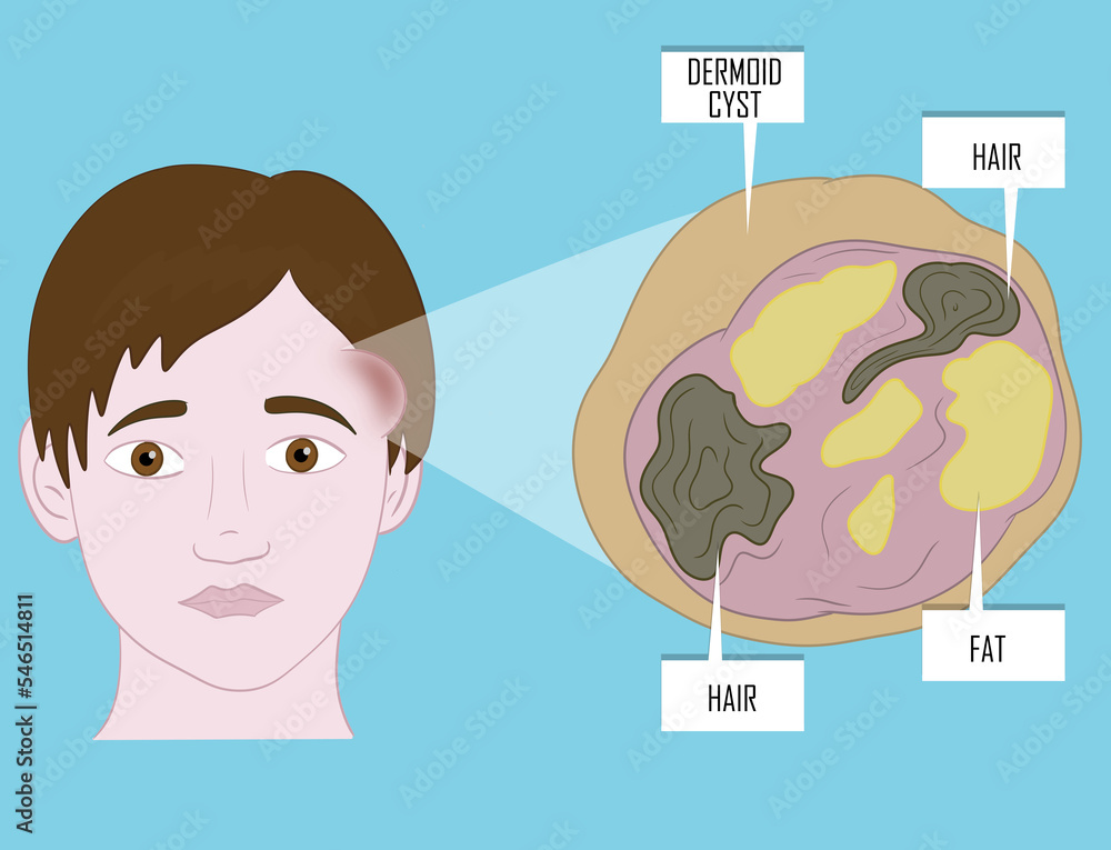 Dermoid cysts symptoms on young patient face. Illustration. Stock ...