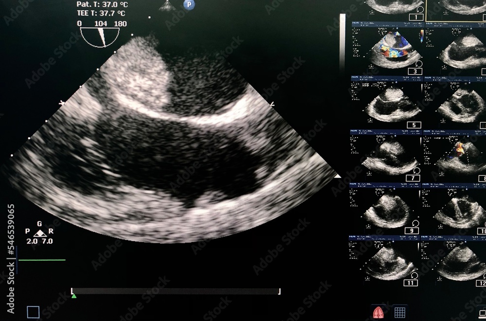 Transesophageal echocardiogram (TEE) shown left atrial (LA) myxoma ...