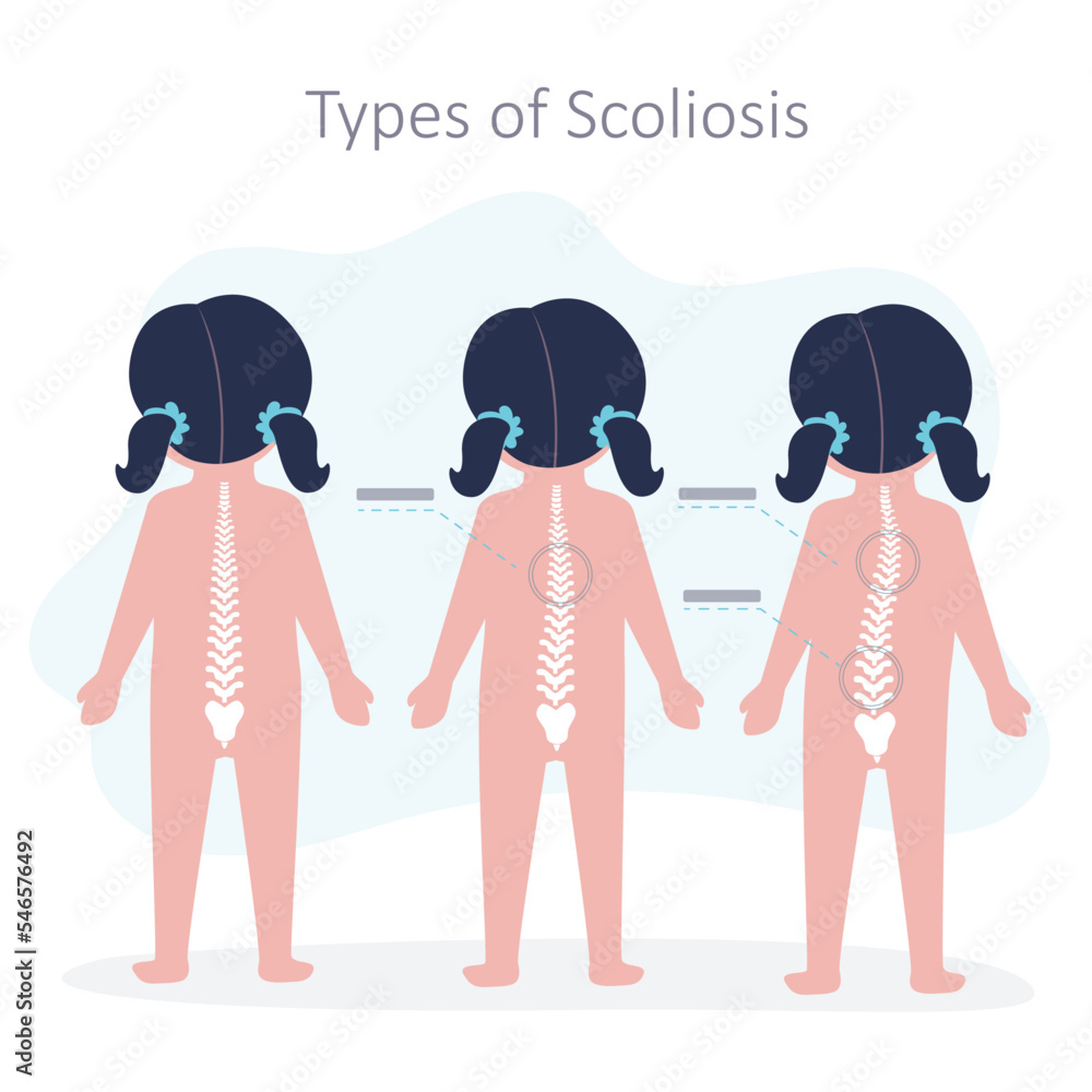 Photo & Art Print Educational poster with different types of scoliosis ...