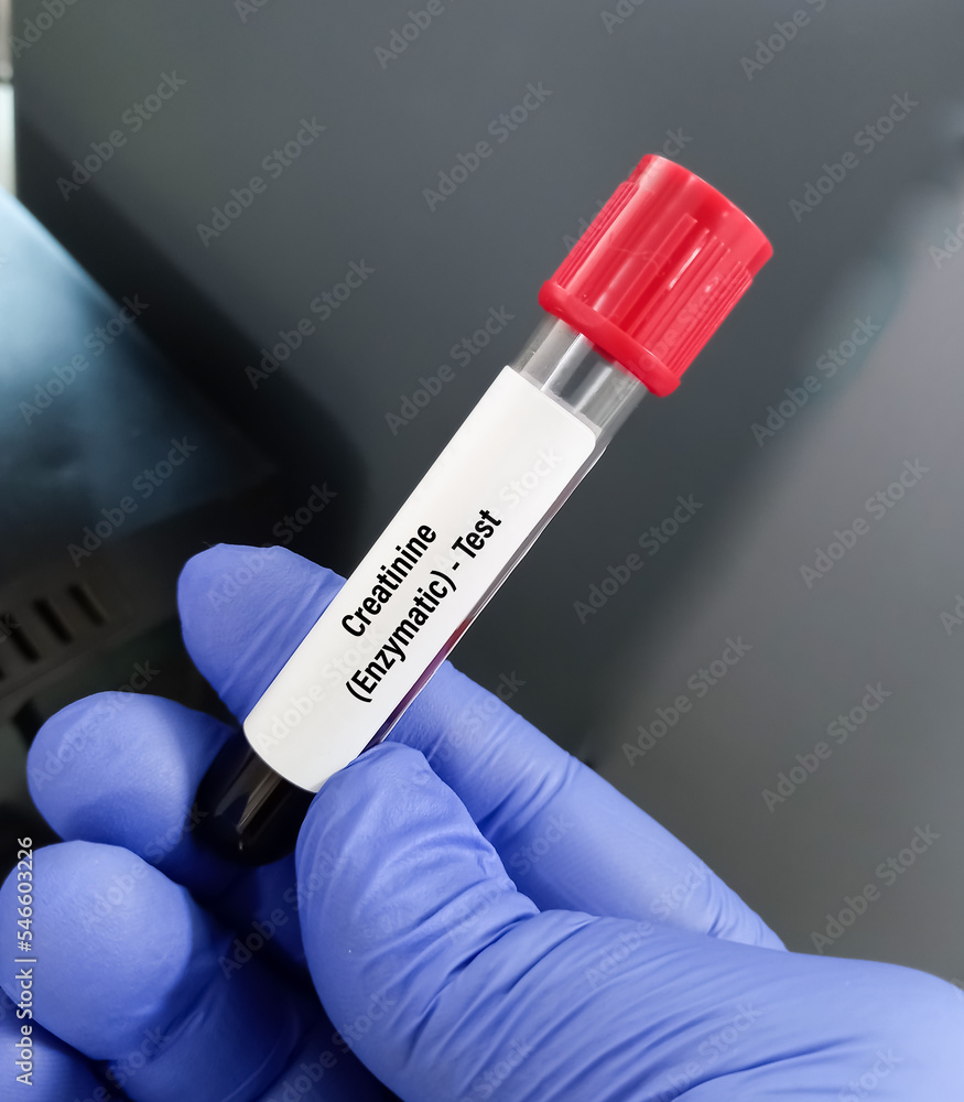 Foto de Blood sample for creatinine enzymatic test. Diagnosis of kidney ...