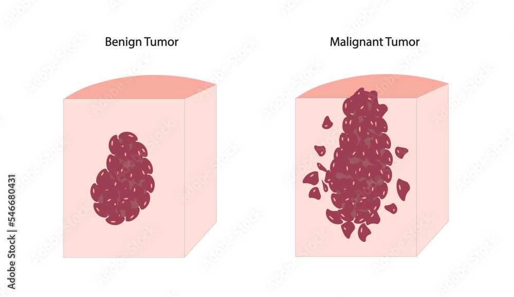 Tumor cells. Benign and malignat tumor illustration in a skin. Stock ...