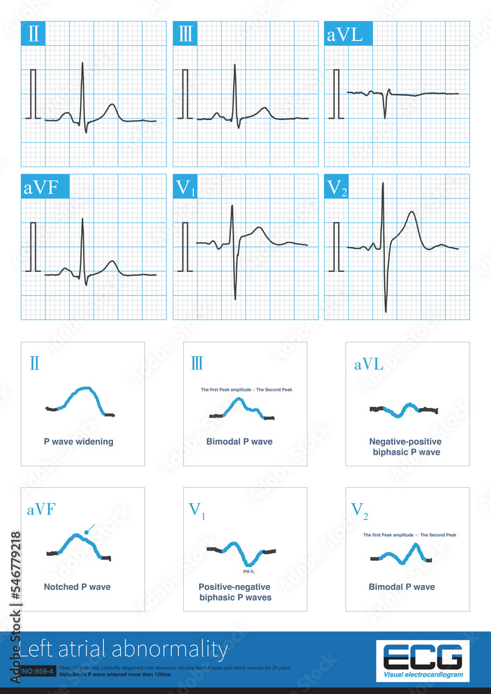 The ECG changes of left atrium abnormality include widening of P wave duration, bimodal P wave ...