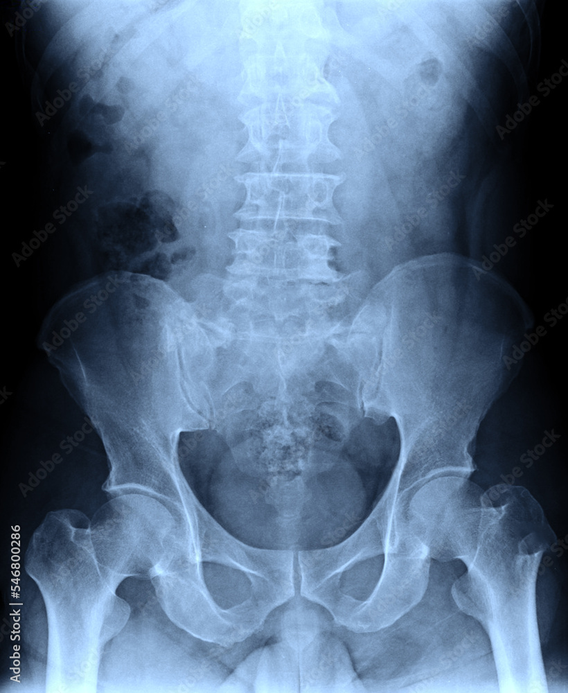 Foto de x-ray images of spine,pelvis,hip joint of patient by mri do ...