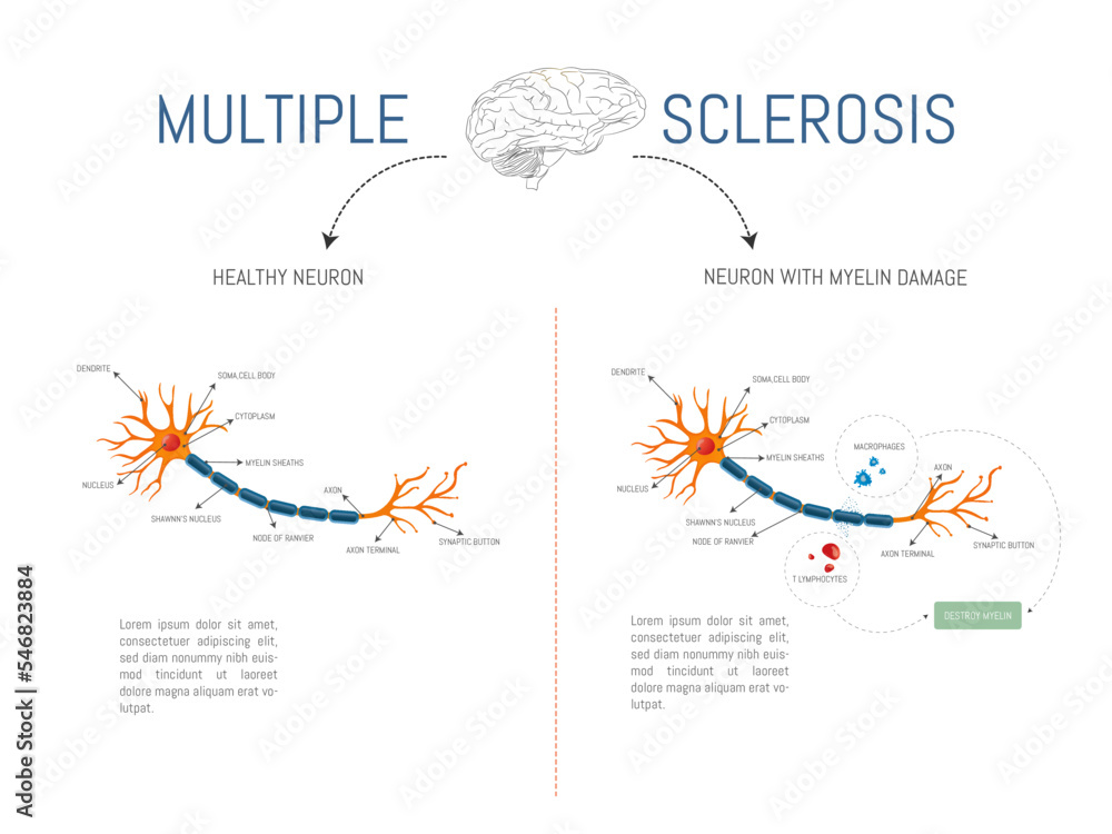 Poster Infographic of a healthy neuron and one with damage from attack ...