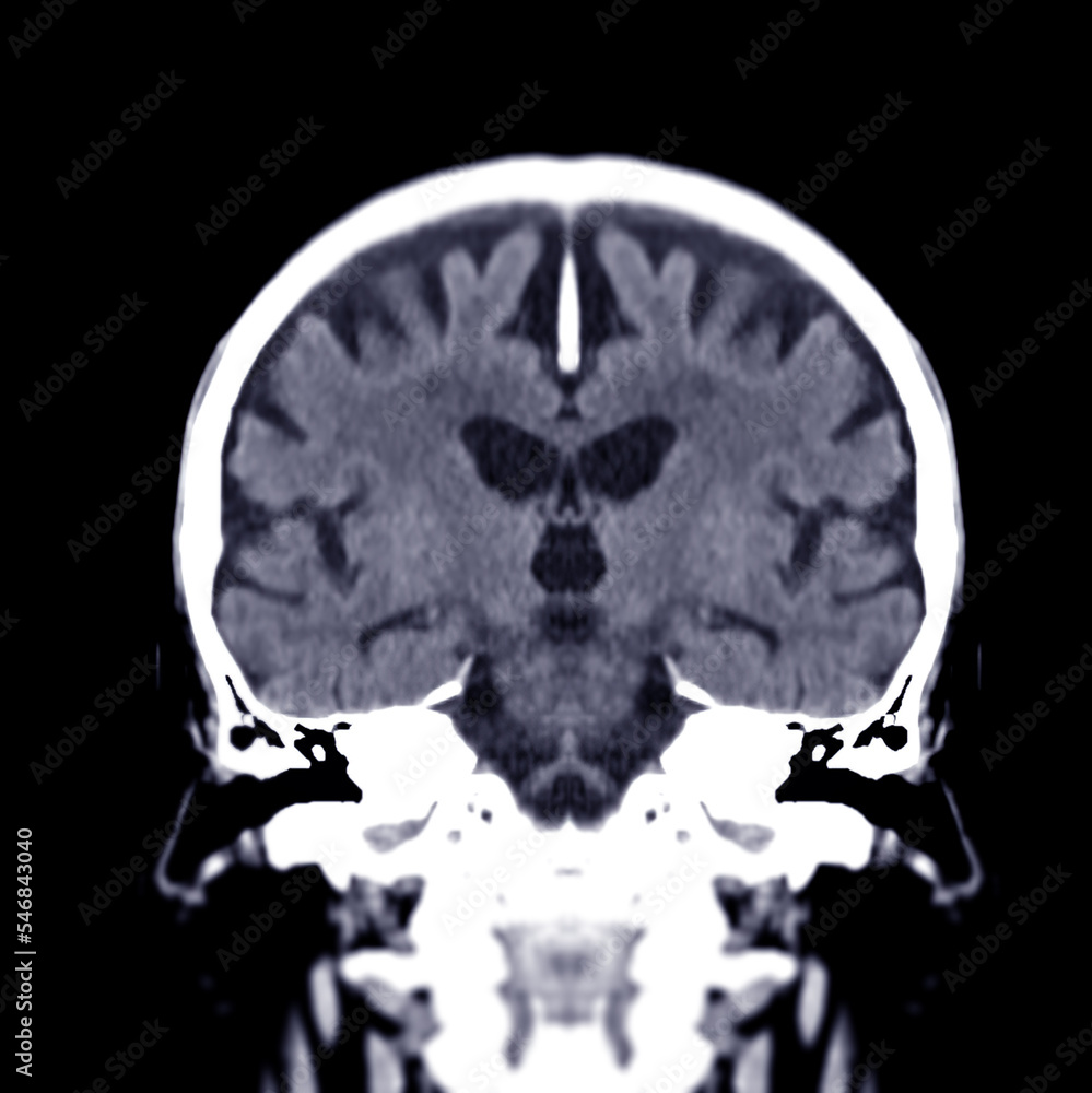CT scan of the brain Coronal view for diagnosis brain tumor,stroke ...