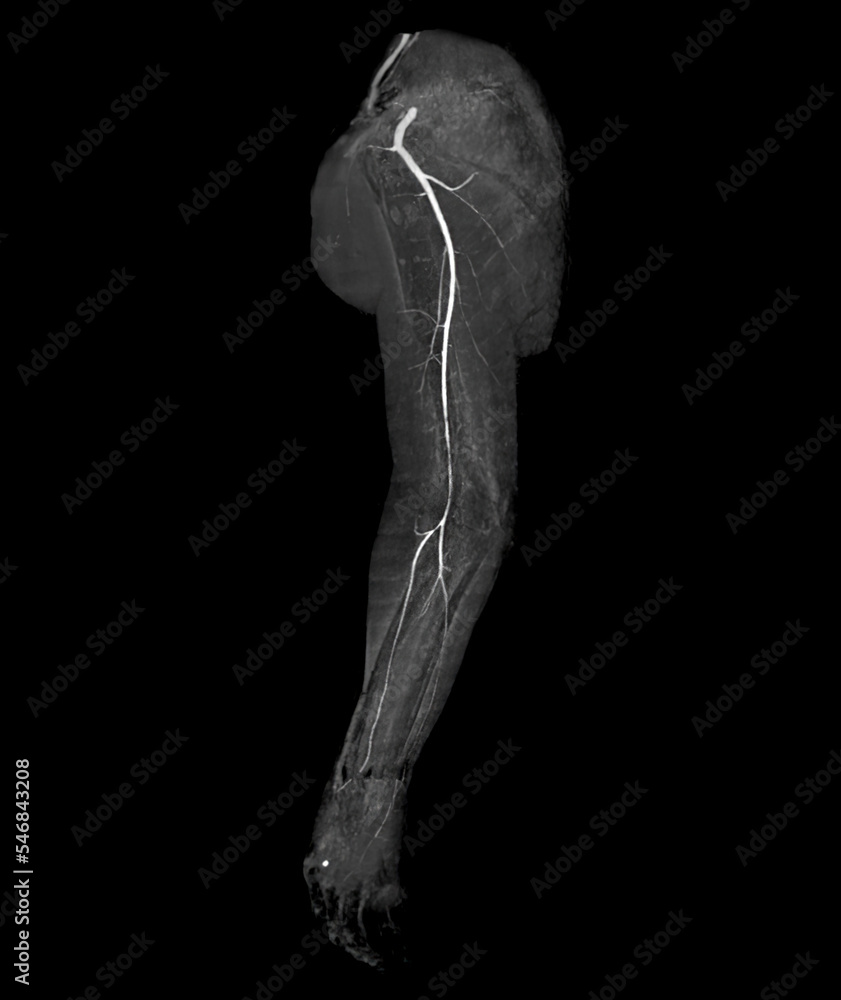 CTA brachial artery or CT scan of upper extremity 3D rendering image ...