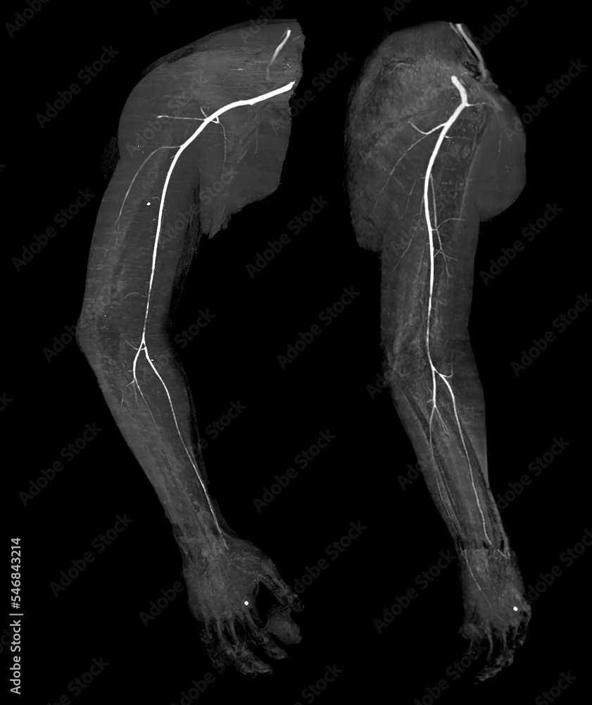 CTA brachial artery or CT scan of upper extremity 3D rendering image ...