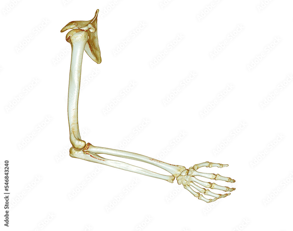 CT SCAN of Arm 3D rendering isolated on white background .Clipping path ...