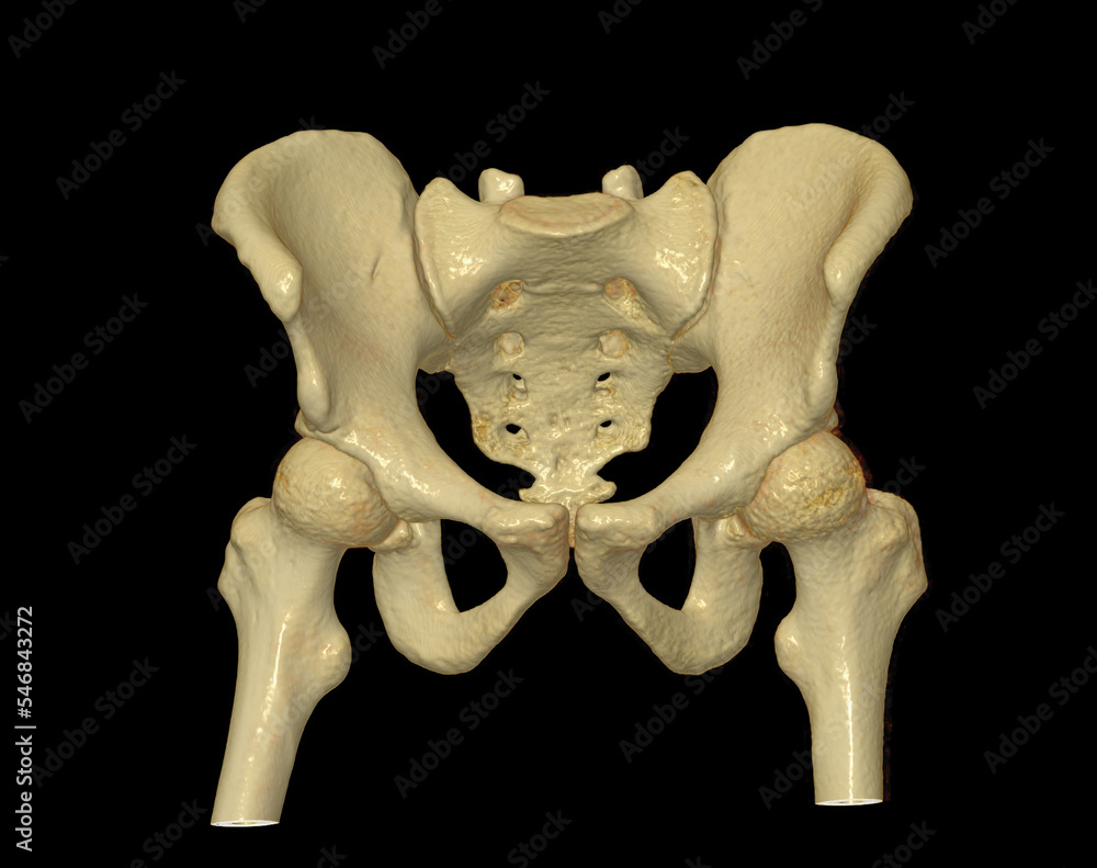 CT scan of Pelvic bone and hip joint 3D rendering for diagnosis ...