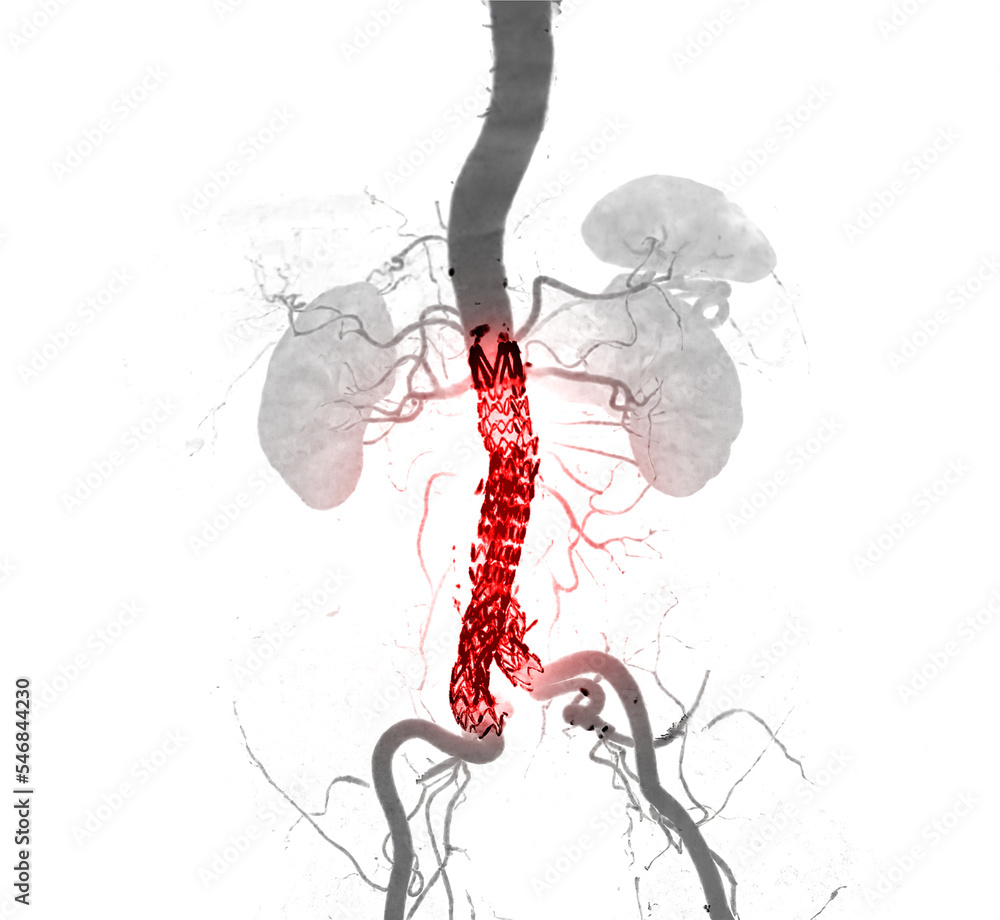 Poster CTA whole aorta with Abdominal aorta stent graft compare 3D ...