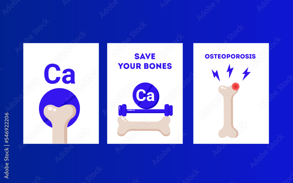 Osteoporosis vector posters. Medical orthopaedic posters with an ...