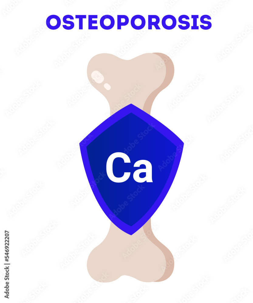 Osteoporosis vector poster. Medical orthopaedic poster with an ...