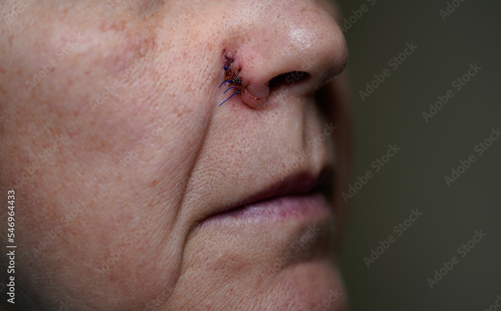 Woman with human papillomas operated on the nose, surgical stitches ...