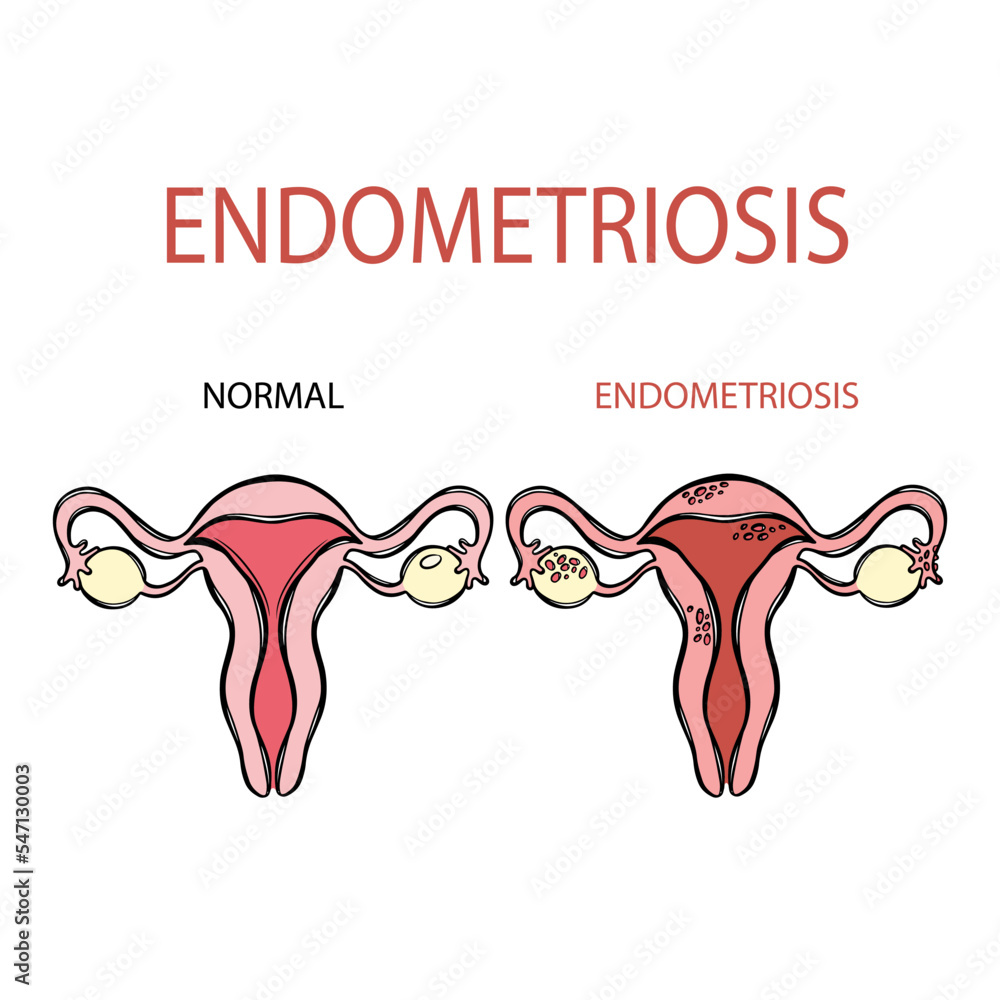 ENDOMETRIOSIS NORMAL FEMALE Reproductive System Cells Similar To Lining ...