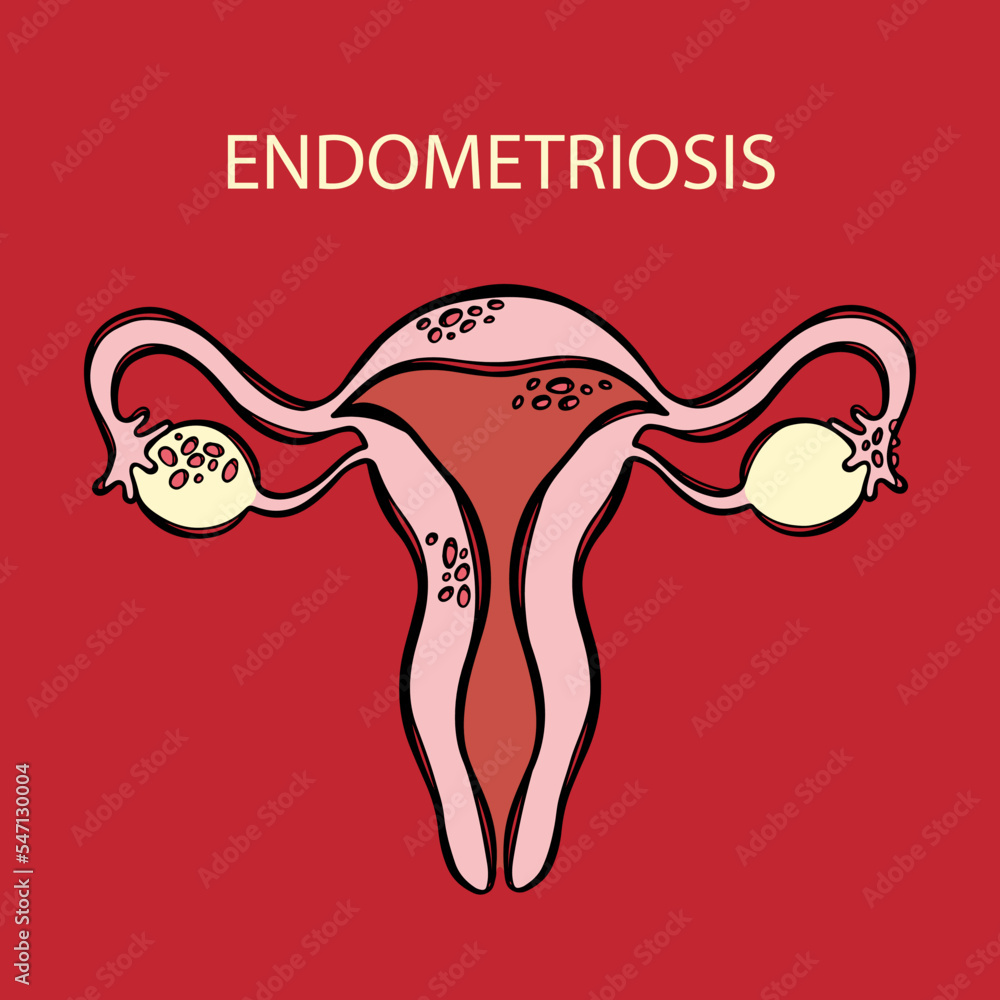 ENDOMETRIOSIS Female Reproductive System Cells Similar To Lining Of ...