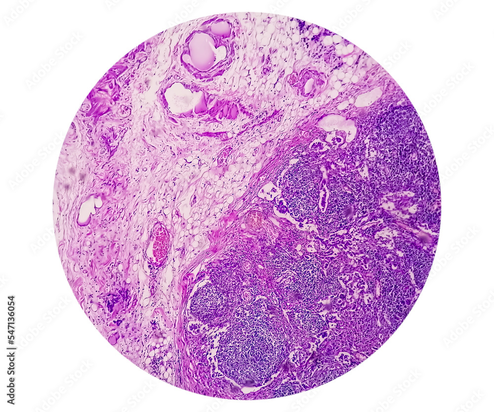 Microscopic view of Trichomonas vaginalis in pap smear with few acute ...