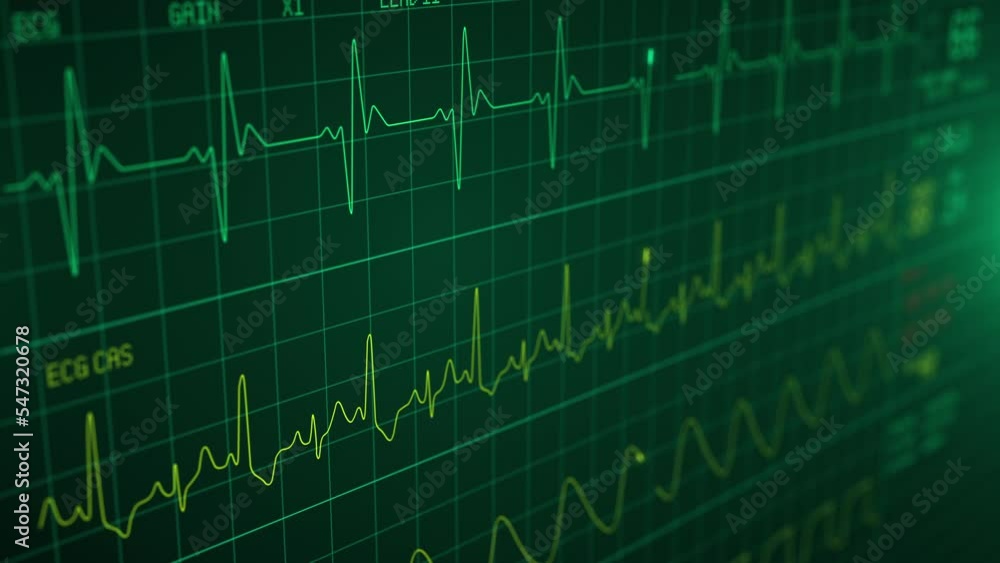 Patient monitor displays vital signs ECG electrocardiogram EKG, oxygen ...
