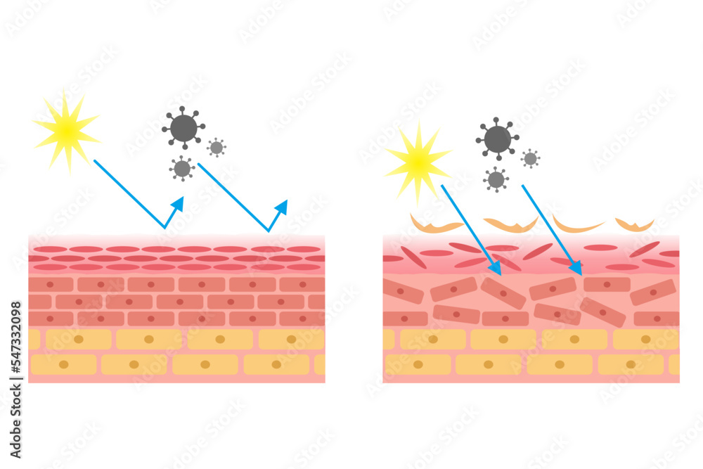 vector illustration of healthy and damaged skin anatomy comparison ...