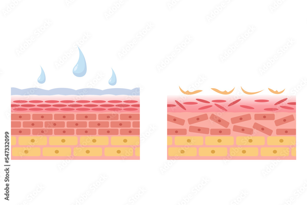 vector illustration of healthy and damaged skin anatomy comparison ...