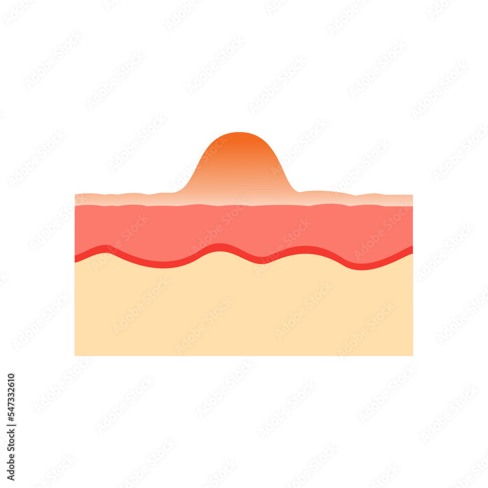 Vector illustration of human skin anatomy. Acne facial skin anatomy ...