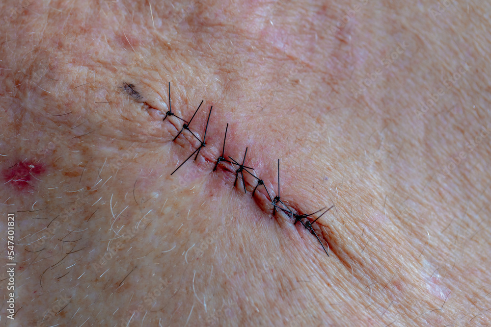 Healthcare and medical concept, Close up man chest with surgical wound ...