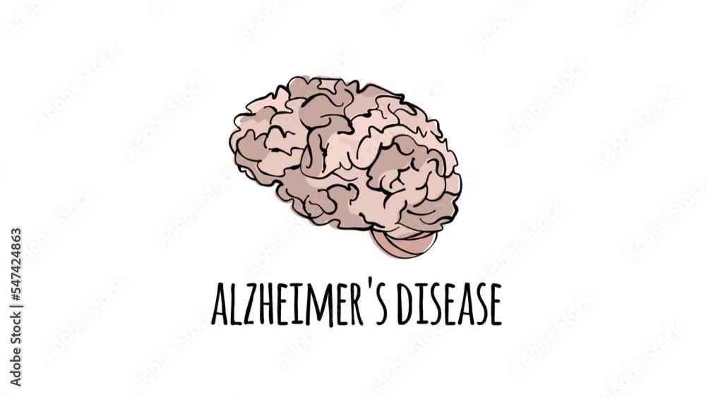 ALZHEIMER Disease Memory Loss Brain Damage Medicine Health Treatment ...