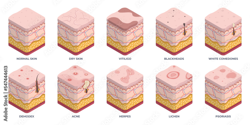 Isometric human skin types, 3d epidermis layers. Dermatology normal ...