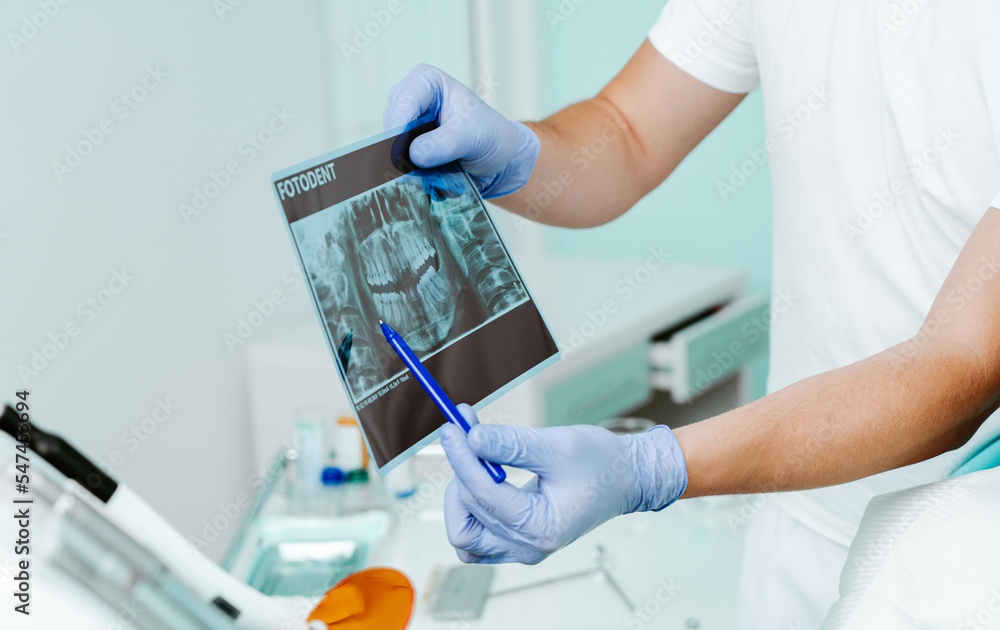 Hands doctor dentist in gloves show the teeth on x-ray foto in dental ...