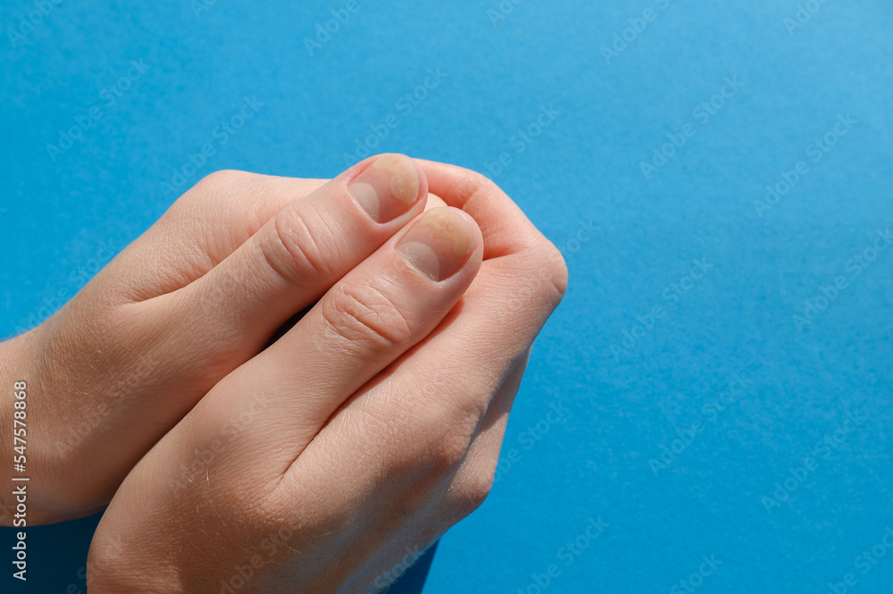 Hands on a blue background with nail lesions - onycholysis.Separation ...