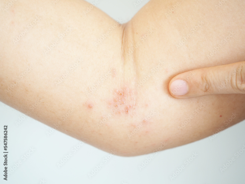 Herpes zoster or shingles symptoms on arm woman. Stock Photo | Adobe Stock