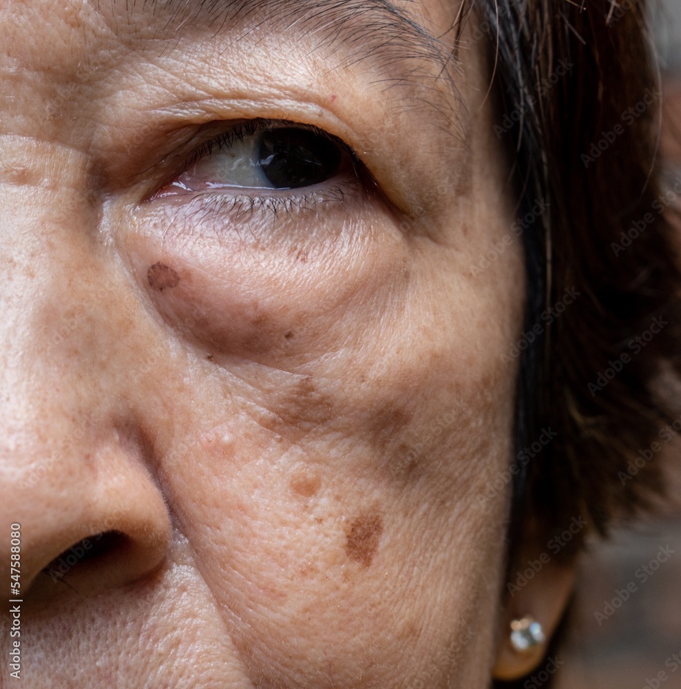 Small Brown Patches Called Age Spots On Face Of Asian Elder Woman They