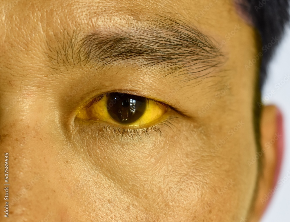 Deep jaundice in Asian male patient. Yellowish discoloration of skin ...