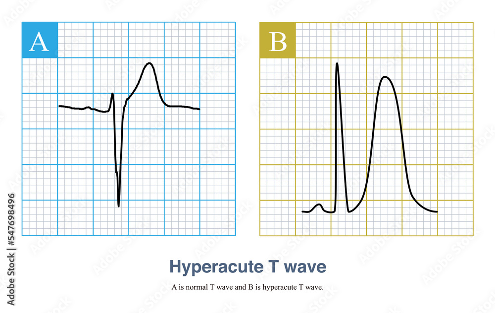 In the earliest stages of acute myocardial ischemia, the upright T wave ...