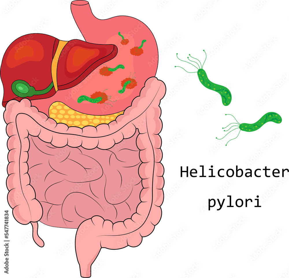 Stomach with Helicobacter pylori. Human anatomy. Stock Illustration | Adobe Stock