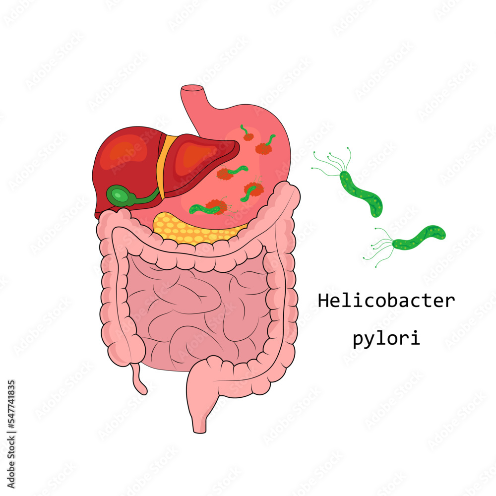 Stomach with Helicobacter pylori. Human anatomy. Stock Vector | Adobe Stock