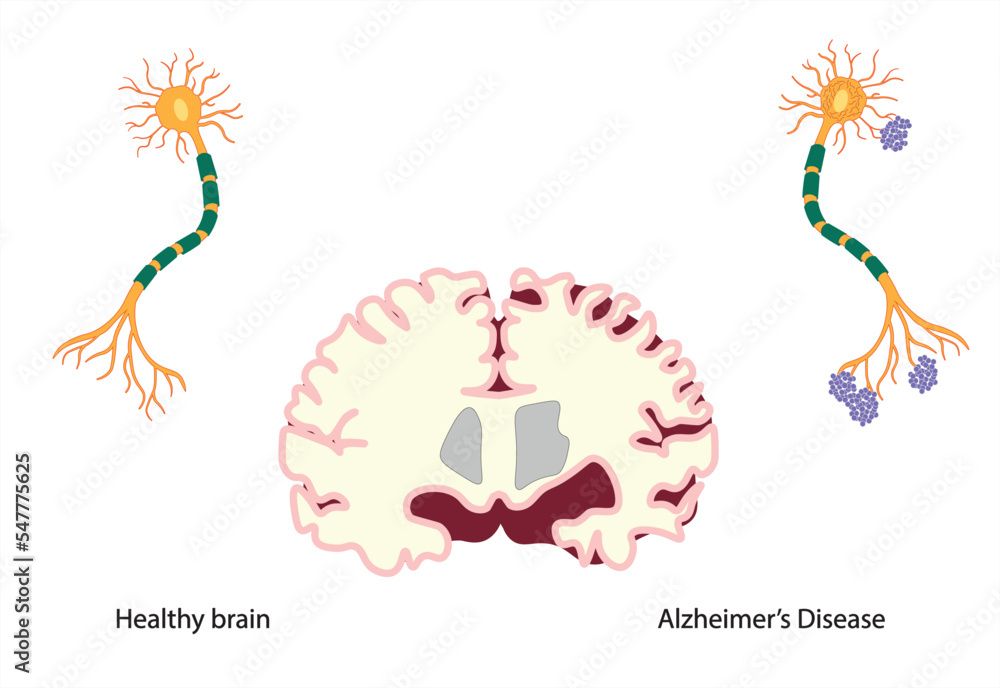 Brain divided in two showing at the left a healthy brain and neuron and ...