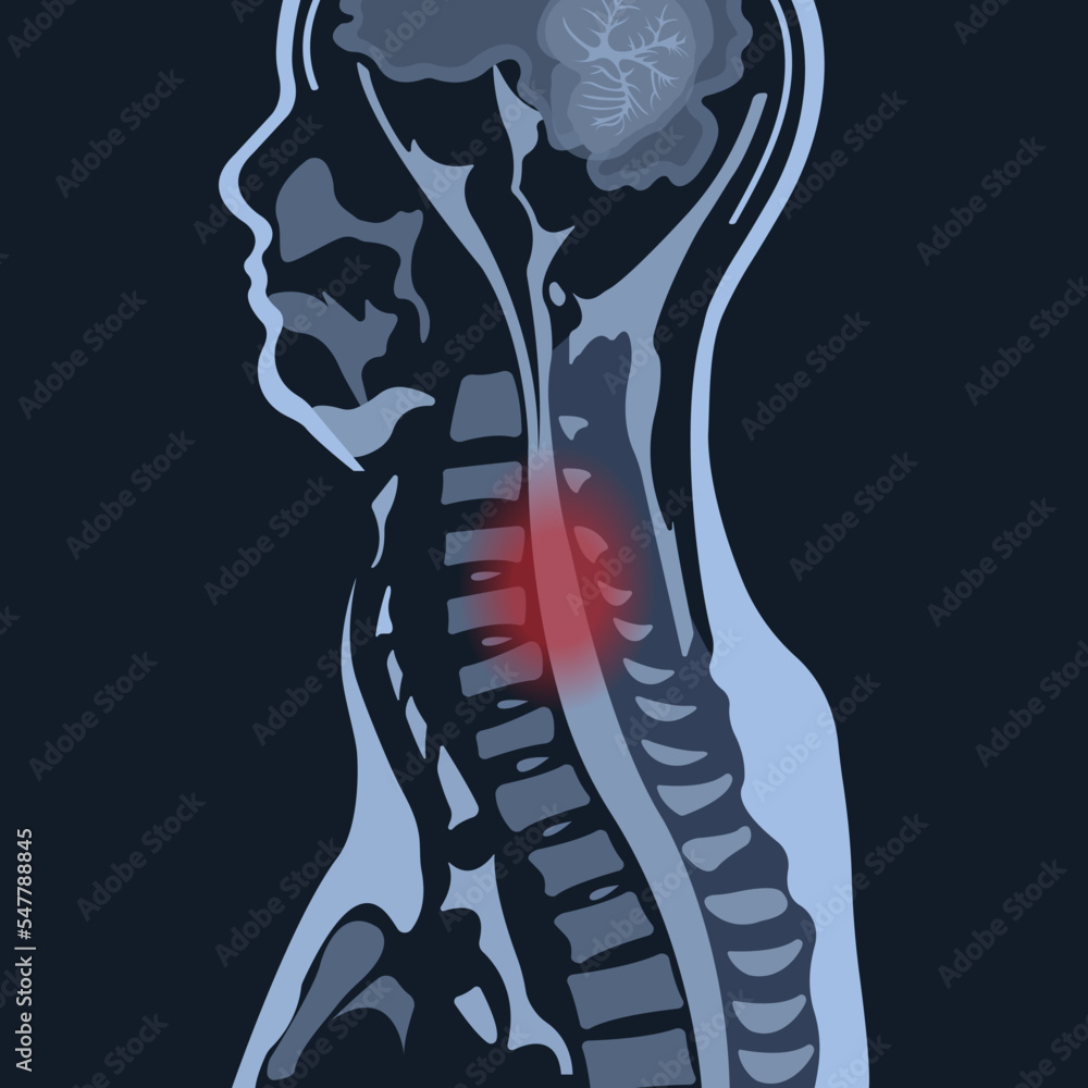 Magnetic resonance imaging of the cervical spine spine, sagittal (MRI ...