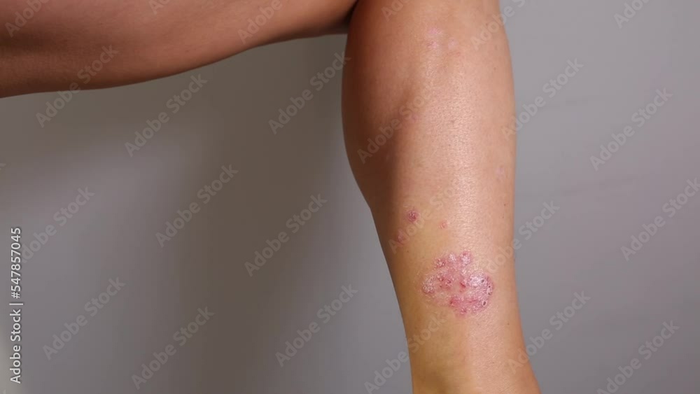 Close-up of an unrecognizable woman, acute psoriasis on her leg, which ...