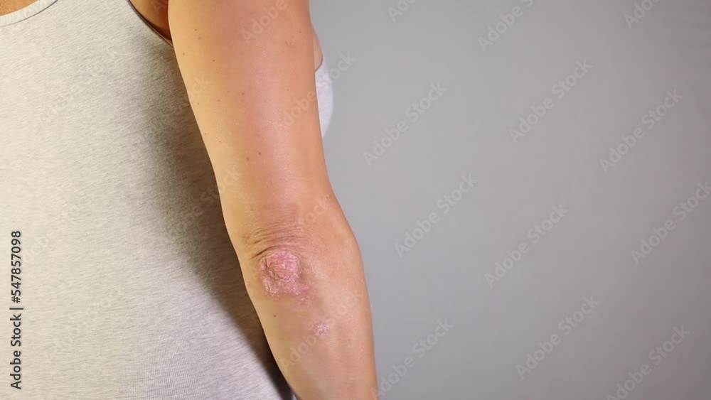 Psoriasis Between The Buttocks At The Coccyx Large Red Inflamed Flaky Rash On The Pilonidal