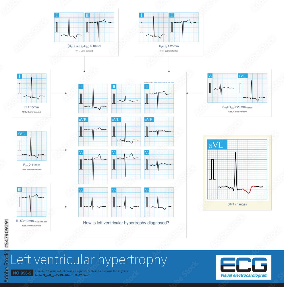 Sometimes, because the QRS axis is in the upper left quadrant, the high ...