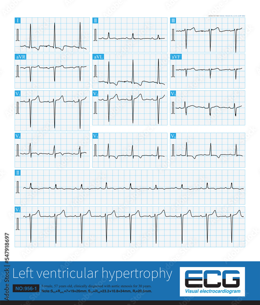 Sometimes, because the QRS axis is in the upper left quadrant, the high ...