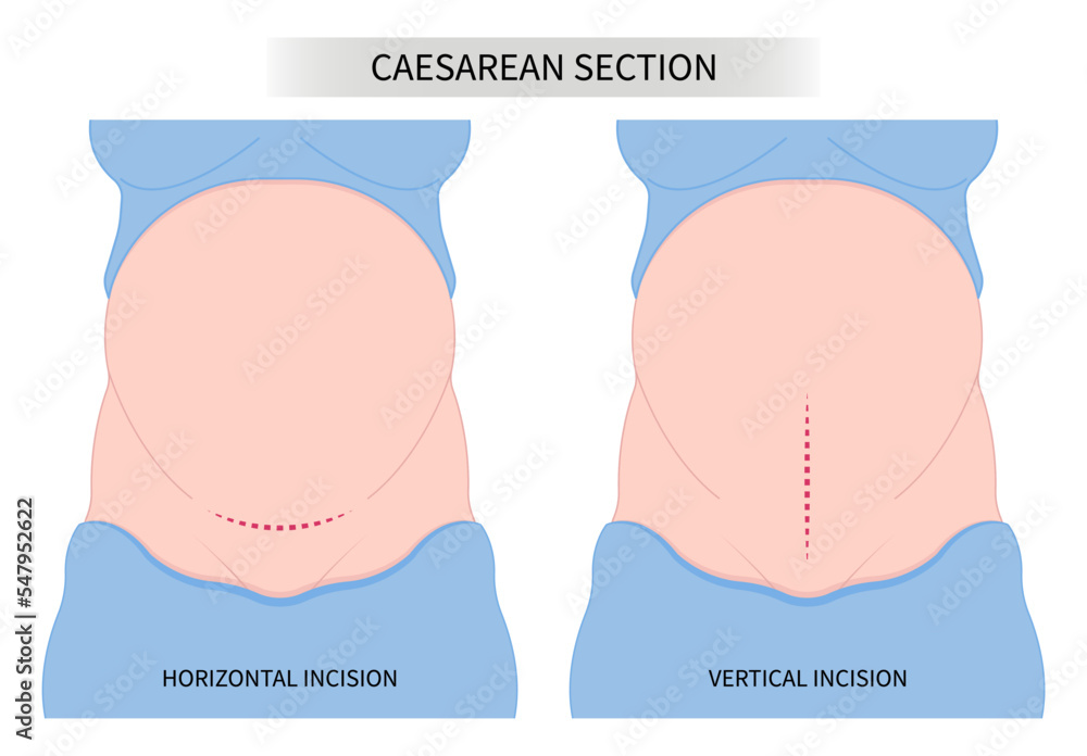 Women tummy belly scar of Pregnancy Newborn Baby birth prolapse ...