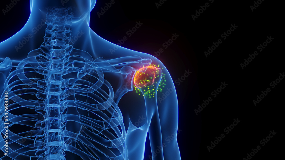 3D rendered Medical Illustration of Male Anatomy - Inflamed Shoulder ...
