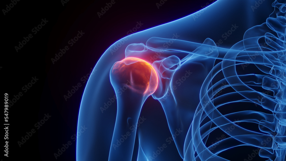 3D rendered Medical Illustration of Male Anatomy - Inflamed Shoulder ...
